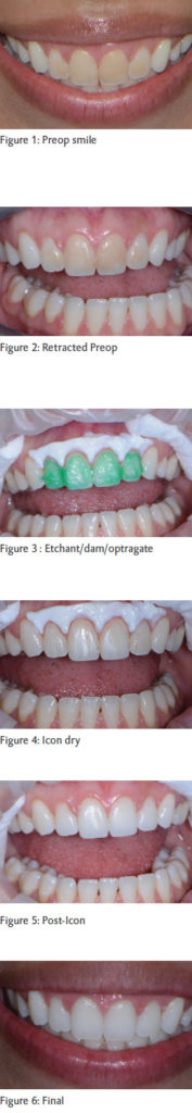 ICON: Minimally Invasive Treatment with Maximal Results - DMG America