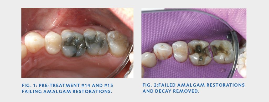 Posterior Composite Restorations - DMG America