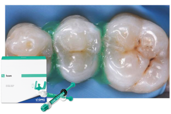 Icon Proximal Case Study - DMG America